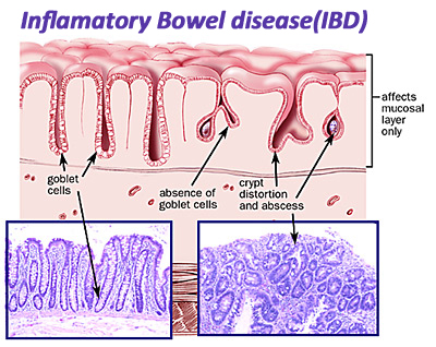 Irritable Bowel Syndrome Homeopathic treatment