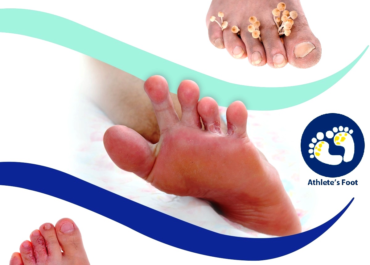 Athlete's Foot Medicine For Ringworm at Alan Fortune blog