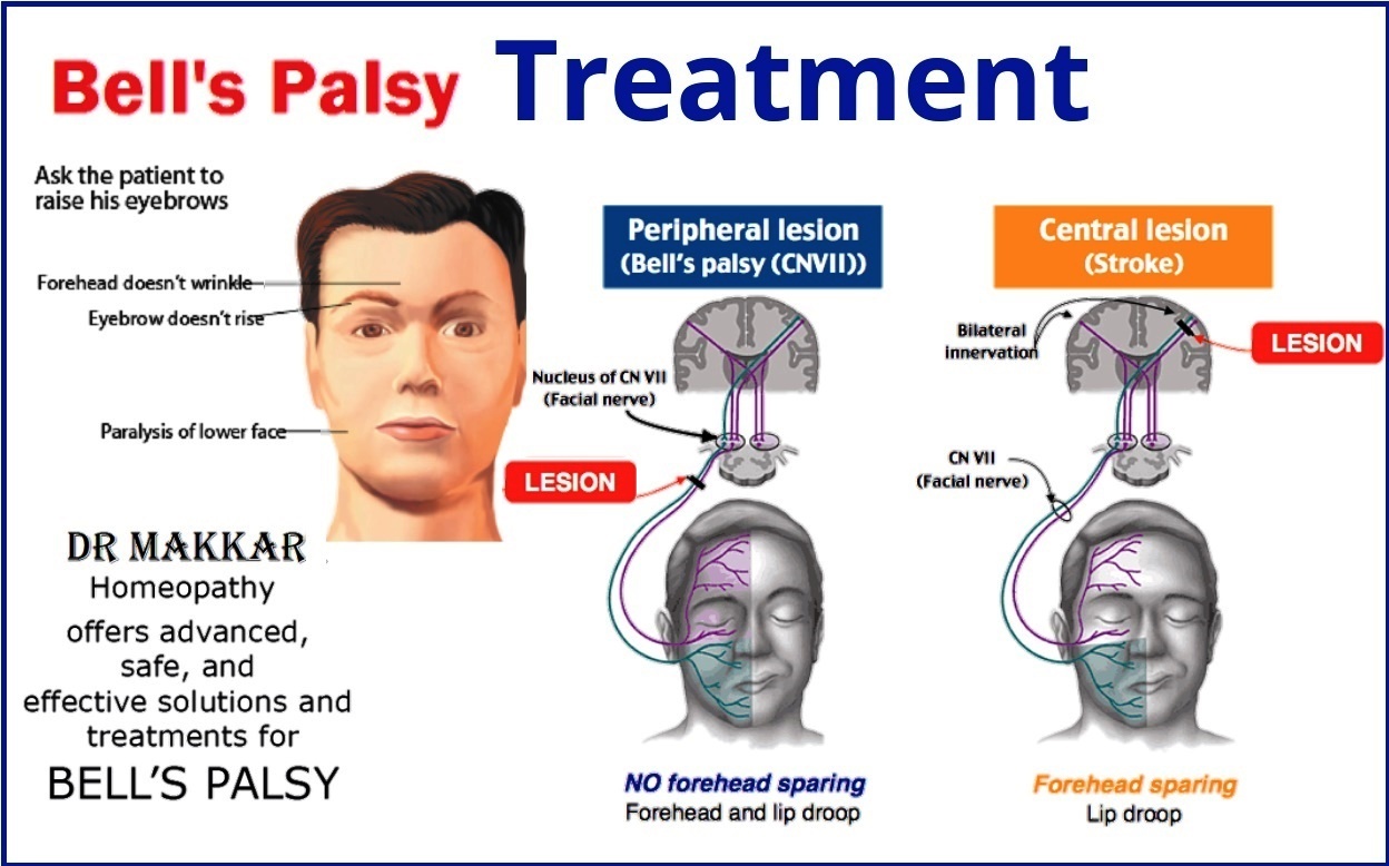 Bell S Palsy Causes Symptoms And Treatment IXXLIQ Bell S Palsy Causes Symptoms And Treatment IXXLIQ
