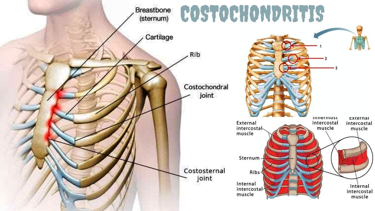 Costochondritis Treatment Costochondritis And Fibromyalgia Treatment Costochondritis Treatment Costochondritis And Fibromyalgia Treatment